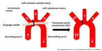 Transverse Aortic Constriction (TAC): Why, how and the outcome as it ...