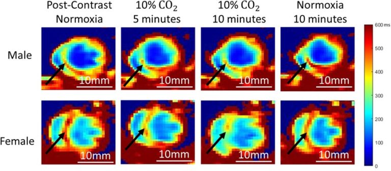 Blood-pool MRI assessment of myocardial microvascular reactivity