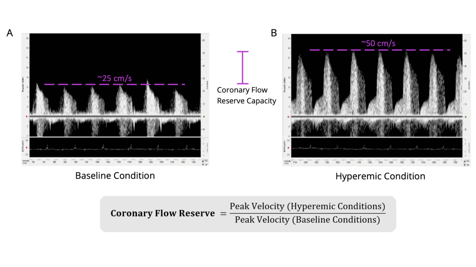 Measuring Coronary Flow Reserve